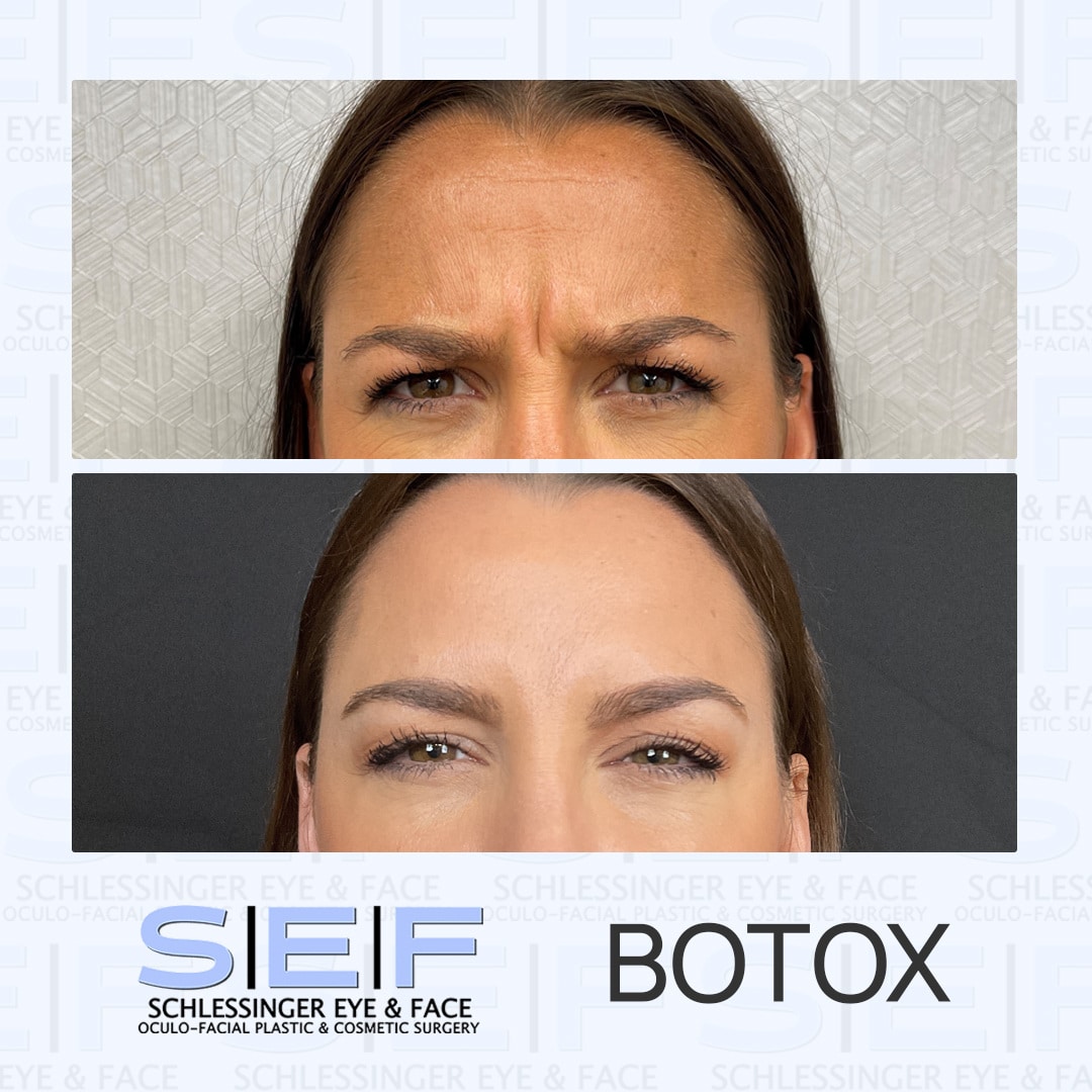 5 Myths About Botox Debunked : Schlessinger Eye and Face