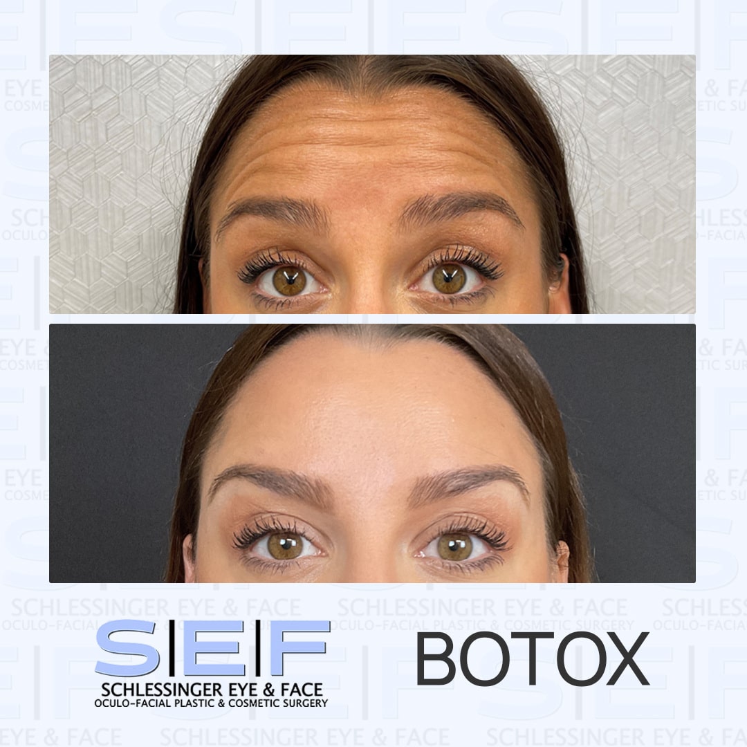 5 Myths About Botox Debunked : Schlessinger Eye and Face