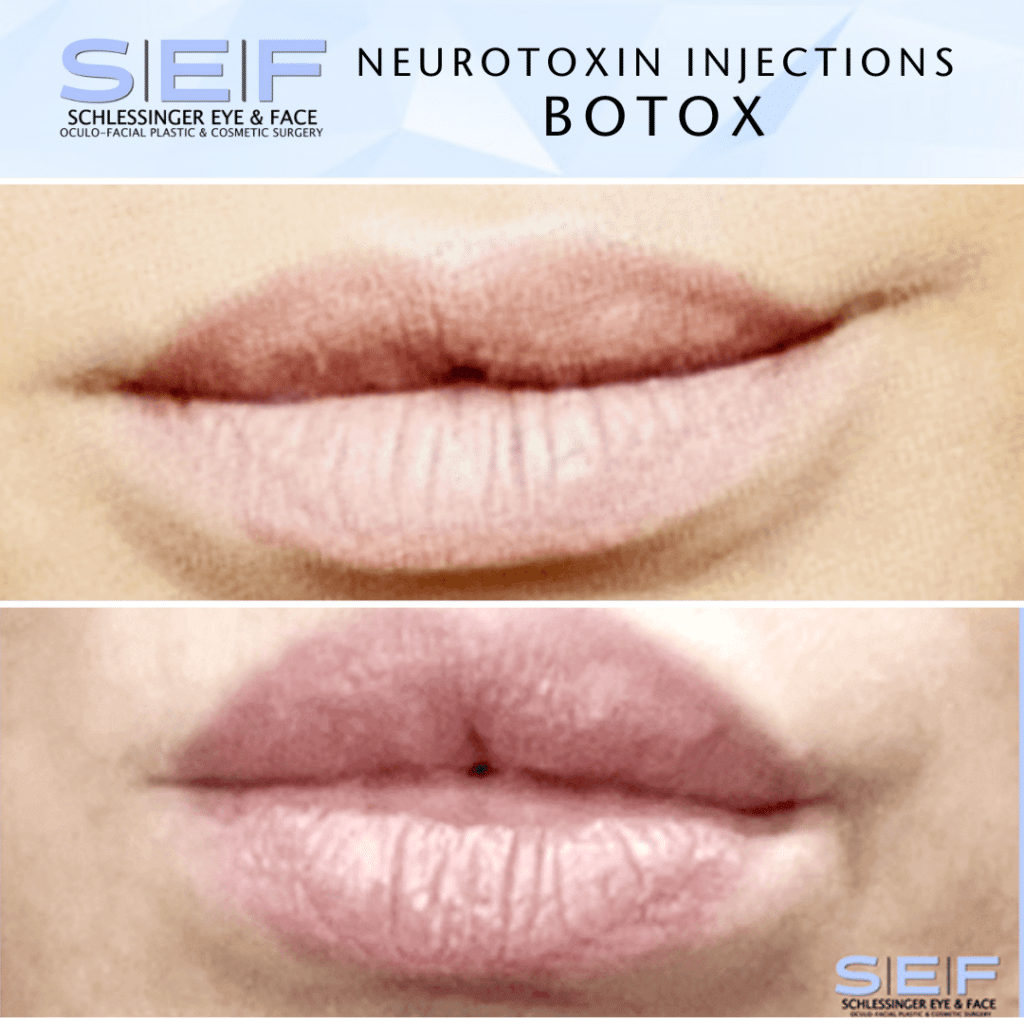 7 Ways Botox Can Improve Your Look : Schlessinger Eye and Face