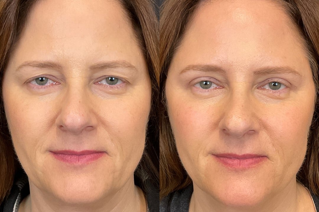5 Signs That You Should Consider a Browlift : Schlessinger Eye and Face