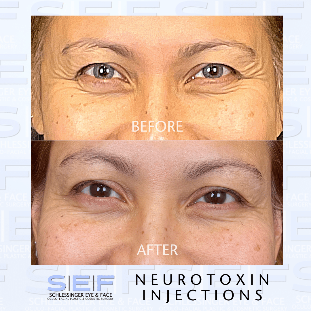 7 Ways Botox Can Improve Your Look : Schlessinger Eye and Face