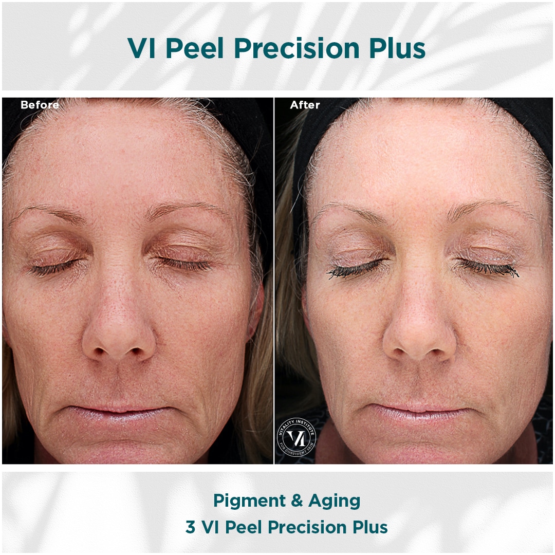 How VI Peels Give You Gorgeous, Youthful Skin : Schlessinger Eye and Face