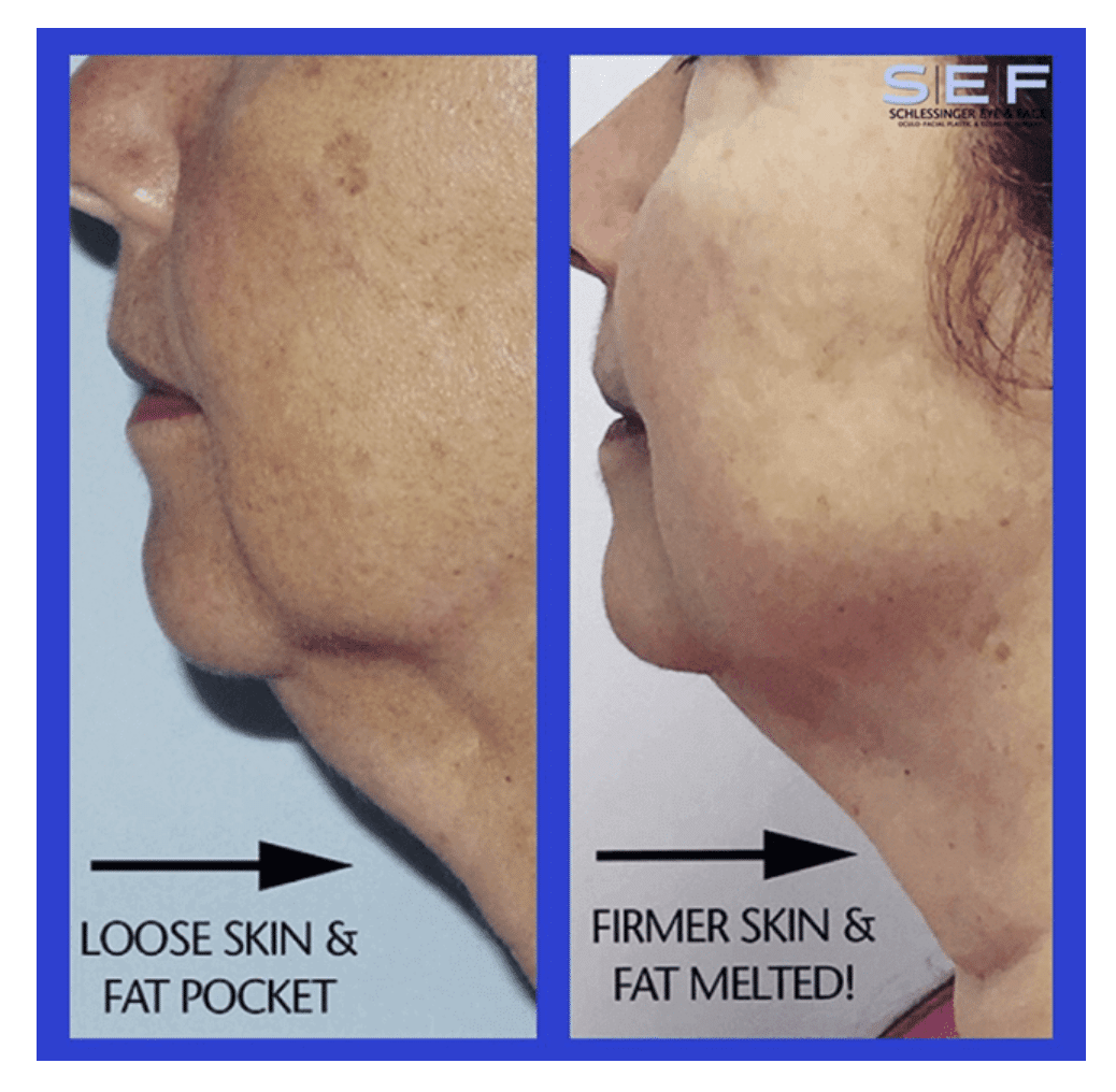 Conquer Turkey Neck with Kybella and Facetite this Season ...