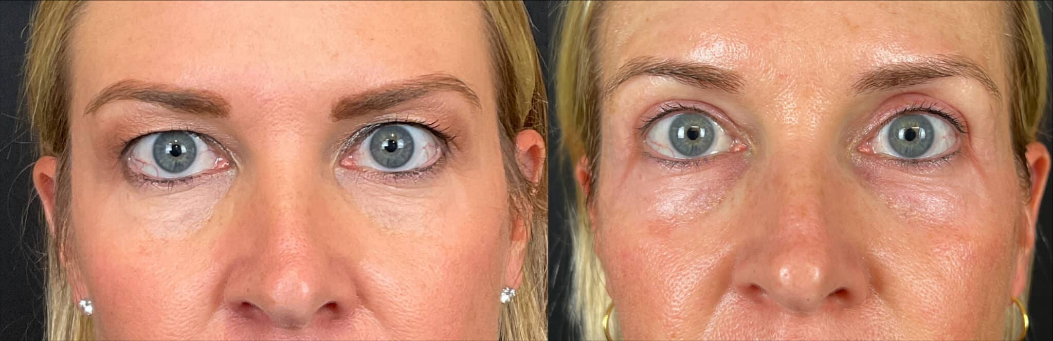 Benefits of a Blepharoplasty for Hooded Eyes : Schlessinger Eye and Face