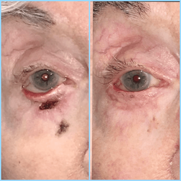Ectropion/Entropion Before & After Gallery | Schlessinger Eye & Face