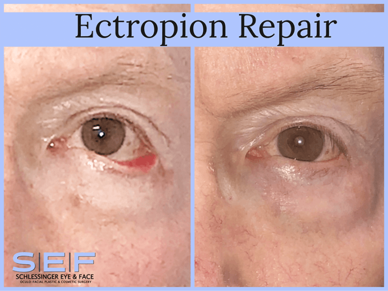 Ectropion/Entropion Before & After Gallery | Schlessinger Eye & Face