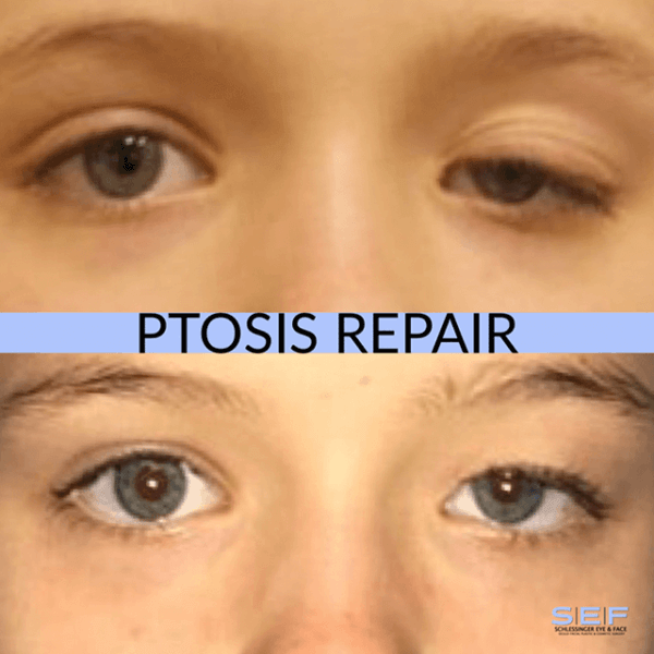 Ptosis Surgery Long Island | Droopy Eyelid Treatment Long Island