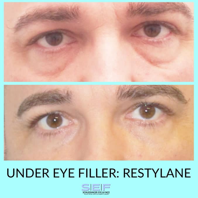 Under Eye Fillers: A Non-Surgical Option for Eye Bag Reduction ...