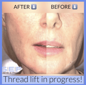 Threadlift Before & After Gallery | Schlessinger Eye & Face Woodbury, NY