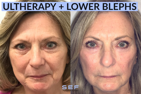 Ultherapy Before & After Gallery | Schlessinger Eye & Face Woodbury, NY